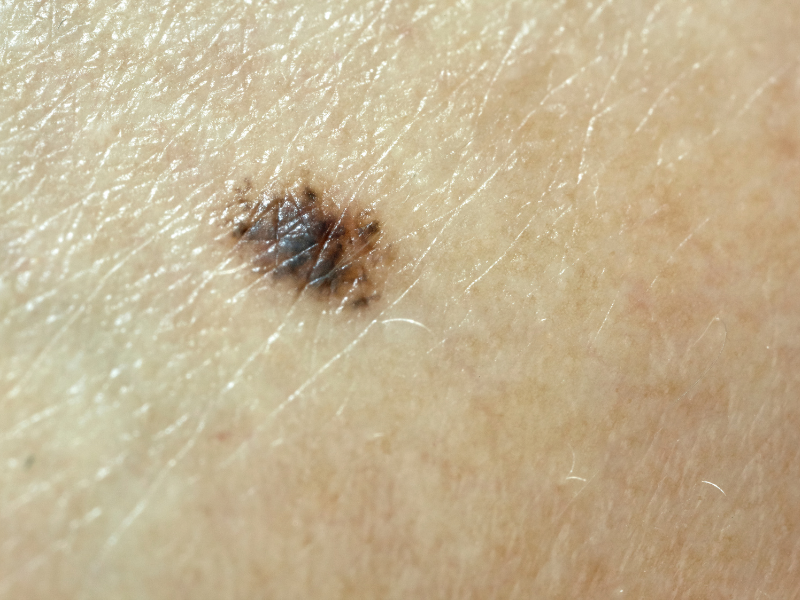 Melanoma Benigno: Entenda Sinais e Tratamentos Disponíveis